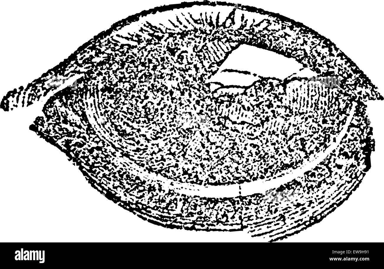 Eye with Vesicular or Pustular Keratitis, vintage engraved illustration ...