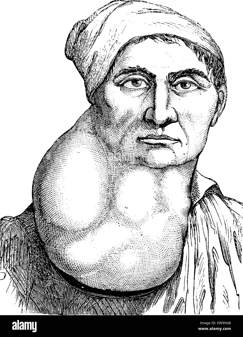 Lymphoma or multiple enlarged lymph nodes in the neck, vintage engraved ...