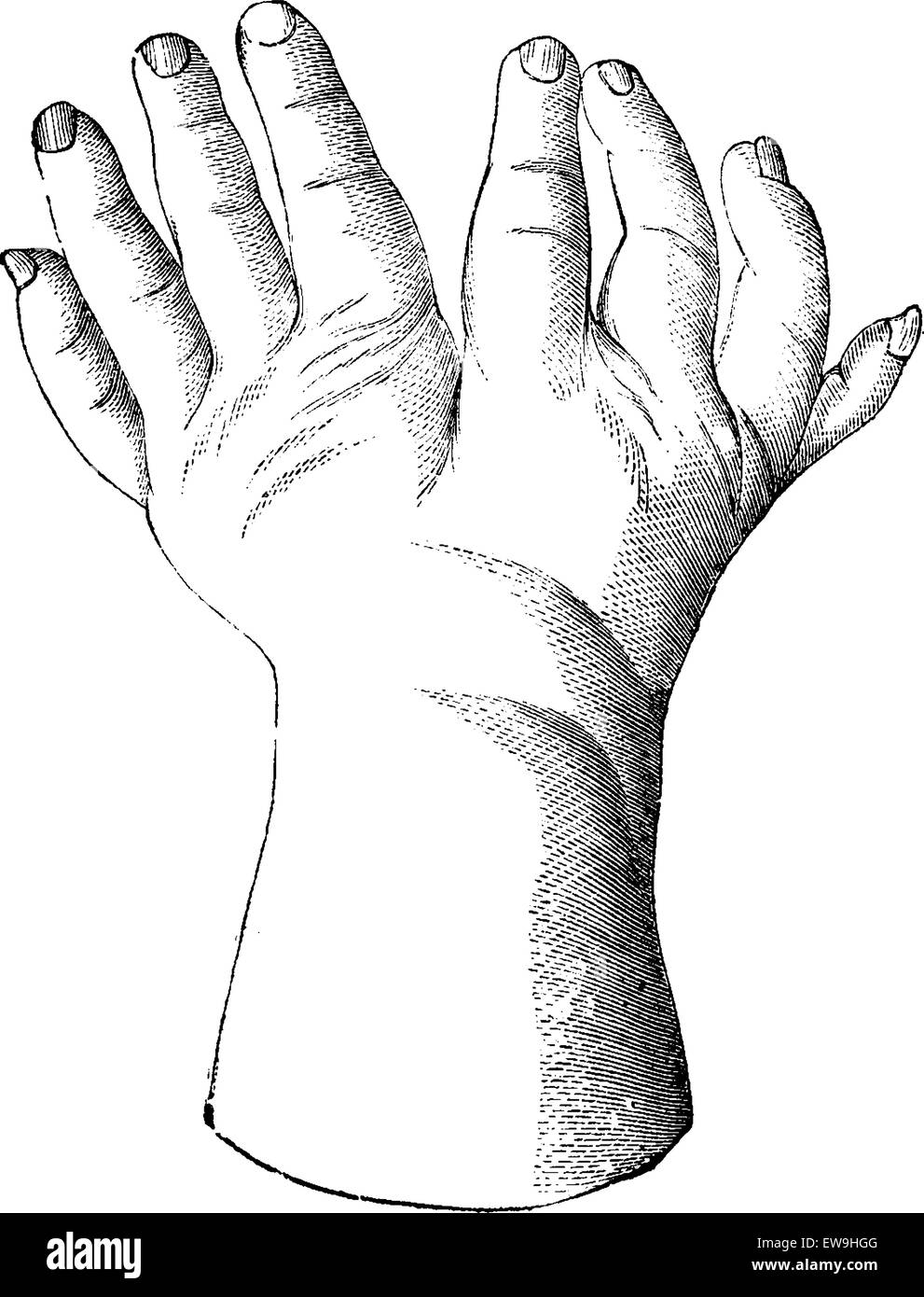 Bifurcated hand, vintage engraved illustration. Usual Medicine ...