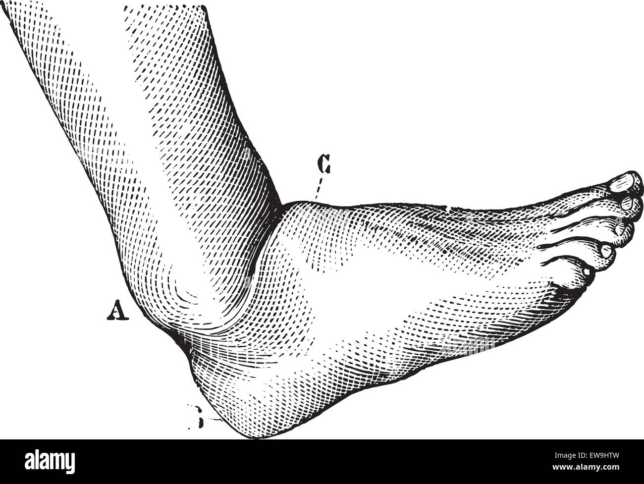 Dislocation of the foot forward, vintage engraved illustration. Usual ...