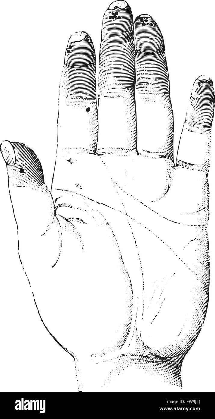 Sclerosis or Sclerotizis of the left hand (palmar surface), vintage ...