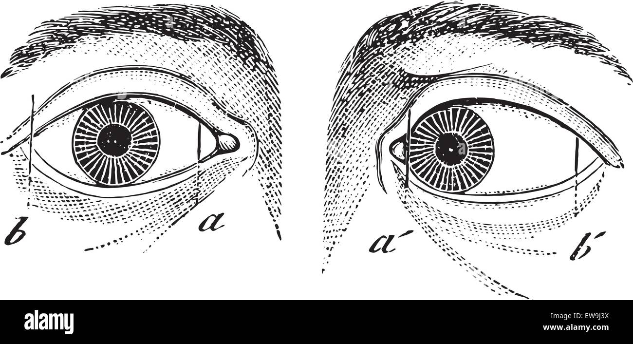 Esotropia of the left eye, vintage engraved illustration. Usual ...