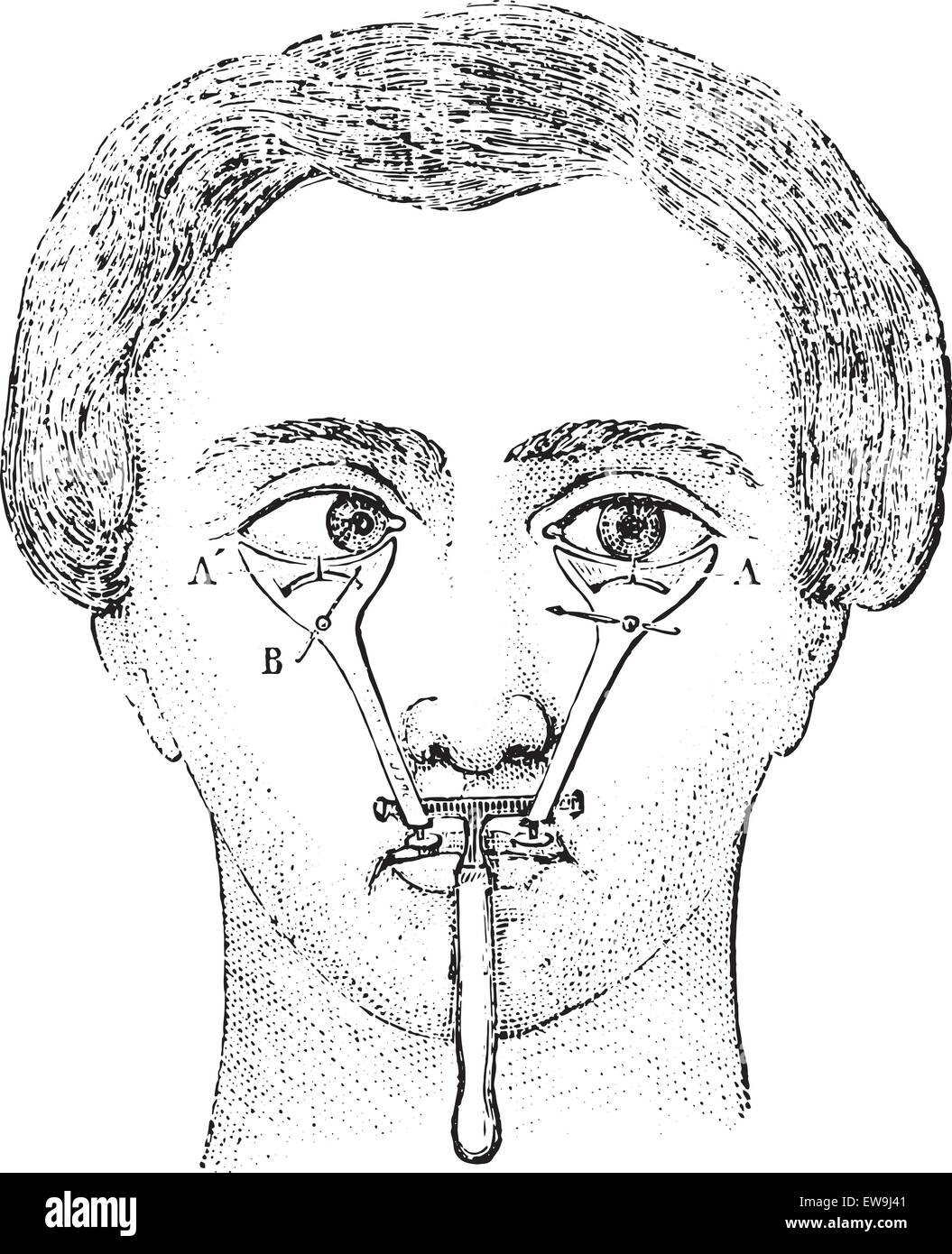 Strabismus surgery hi-res stock photography and images - Alamy