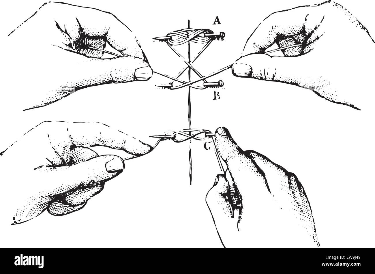 Twisted suture, vintage engraved illustration. Usual Medicine ...