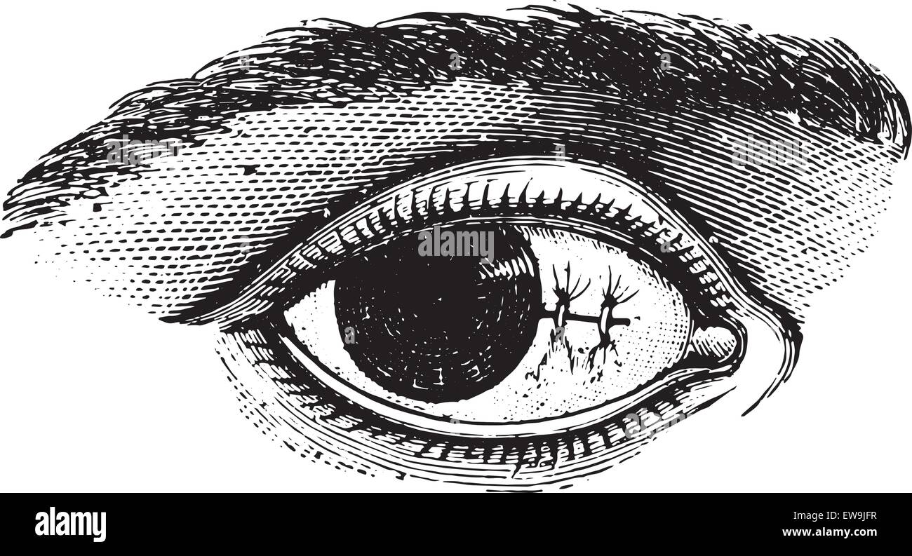 Suture of the conjunctiva after excision of pterygium, vintage engraved ...