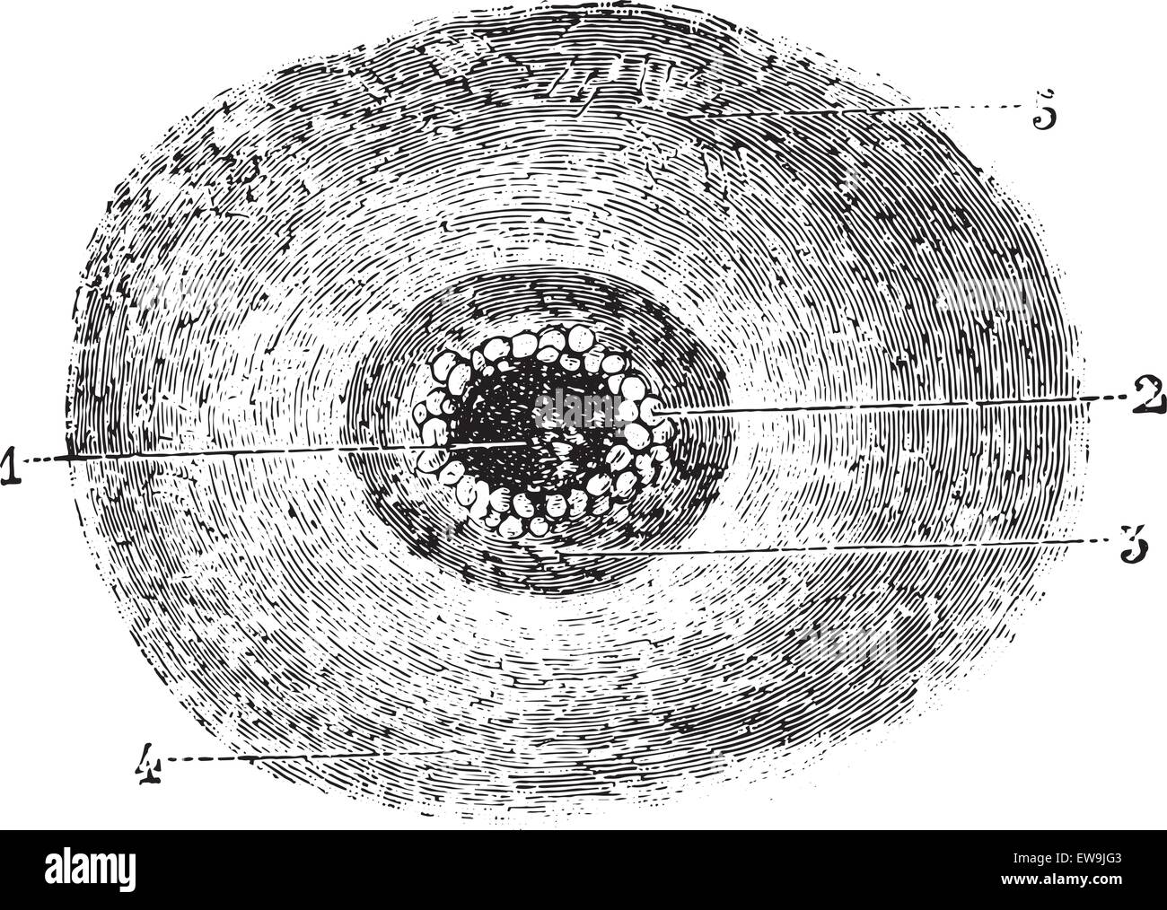 Malignant pustule or Anthrax, vintage engraved illustration. Usual ...