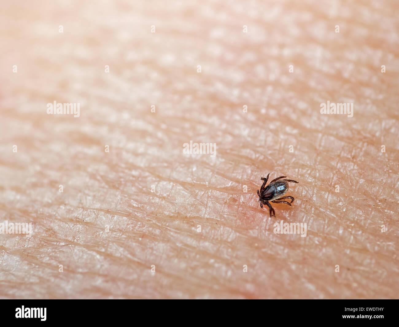Small tick insect with head buried in human skin. Disease risk Stock ...