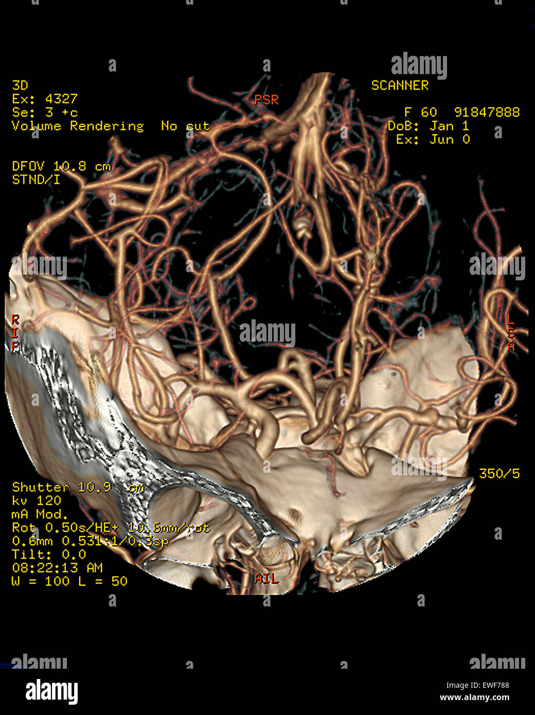 CEREBRAL ATROPHY, CT-SCAN Stock Photo, Royalty Free Image: 84542872 - Alamy