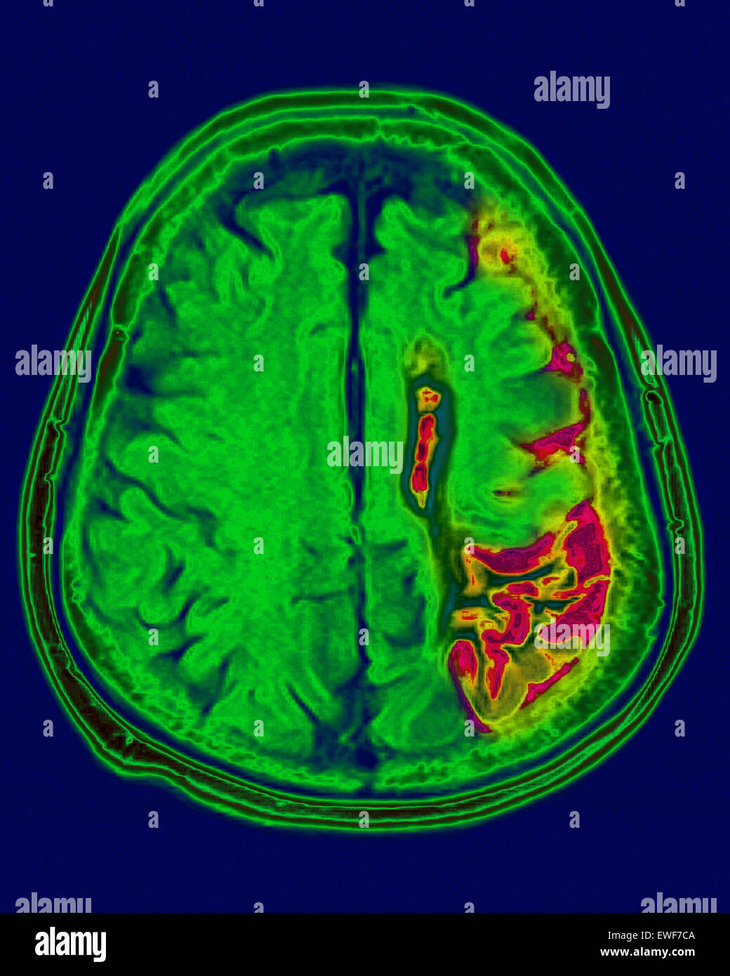 CEREBRAL ATROPHY, MRI Stock Photo - Alamy