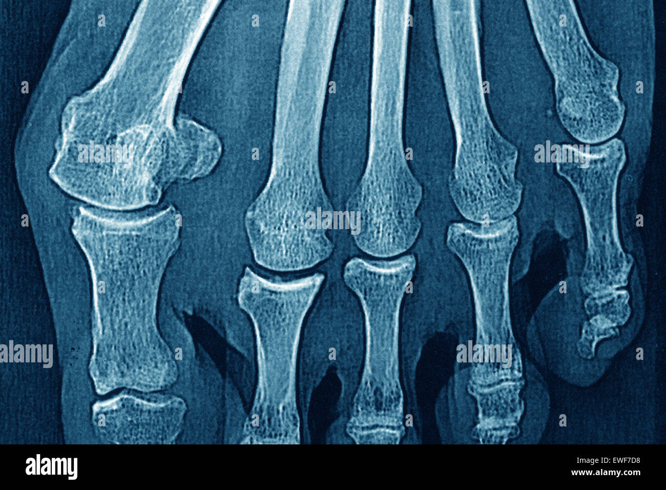 HALLUX VALGUS, X-RAY Stock Photo - Alamy