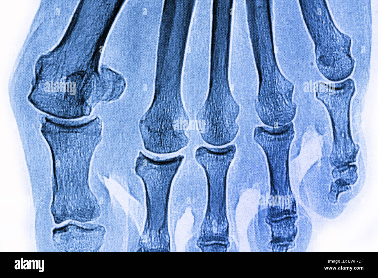 Hallux Valgus X Ray