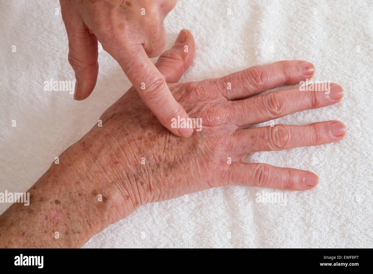 Liver Spots Hands High Resolution Stock Photography and Images - Alamy