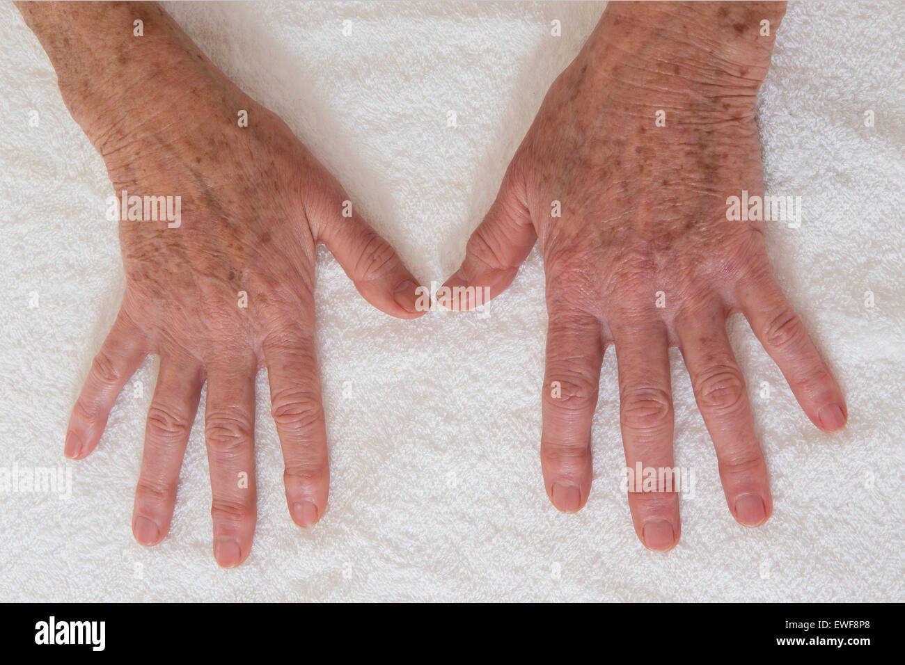 Solar Lentigo High Resolution Stock Photography and Images - Alamy