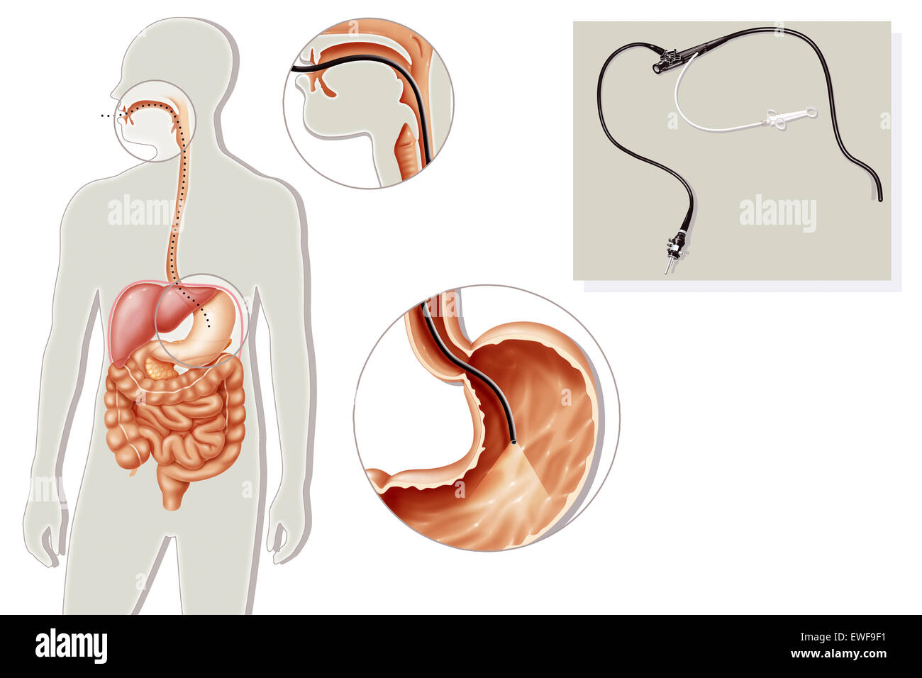 GASTROSCOPY, ILLUSTRATION Stock Photo - Alamy