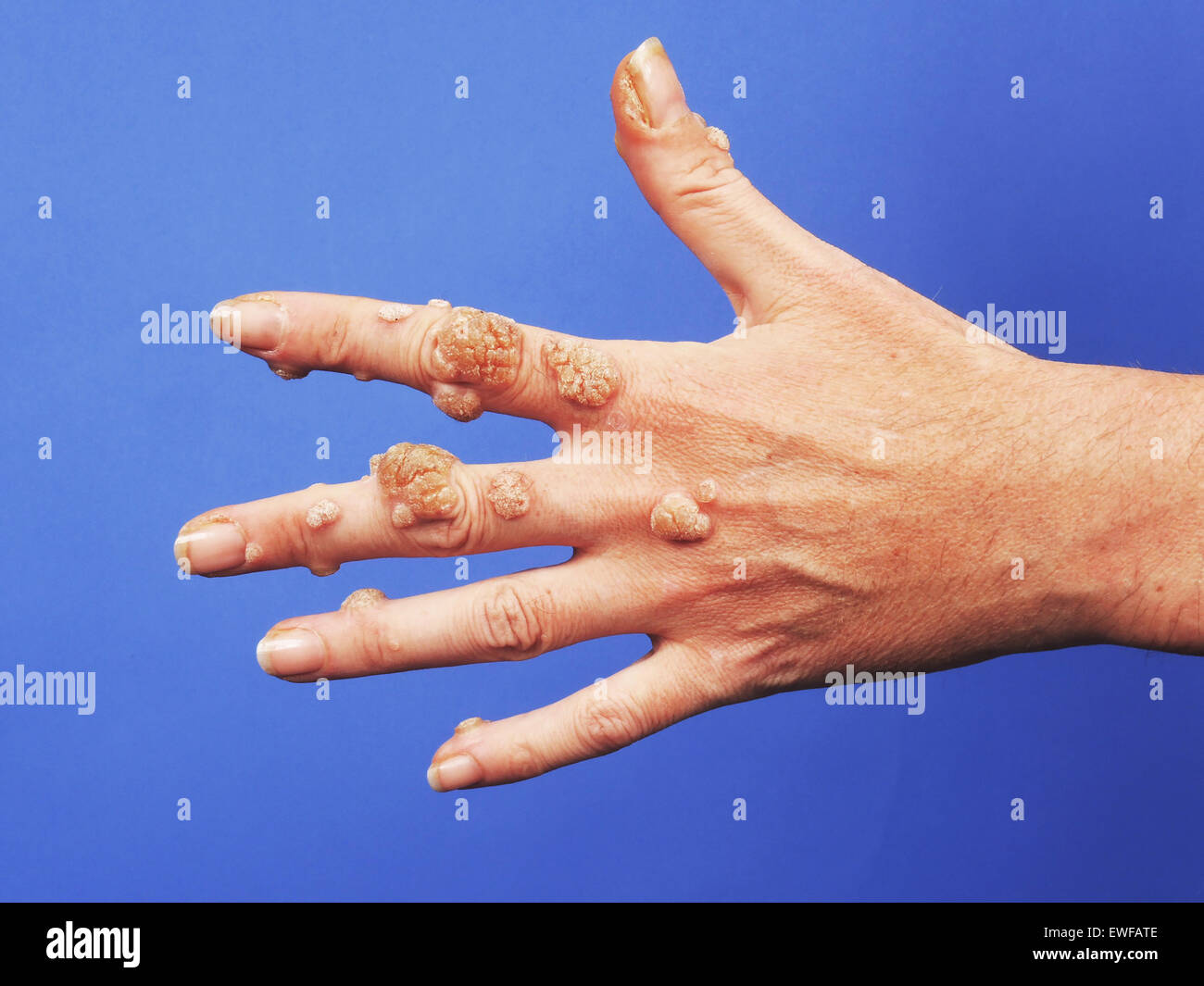 Wart finger hi-res stock photography and images - Alamy