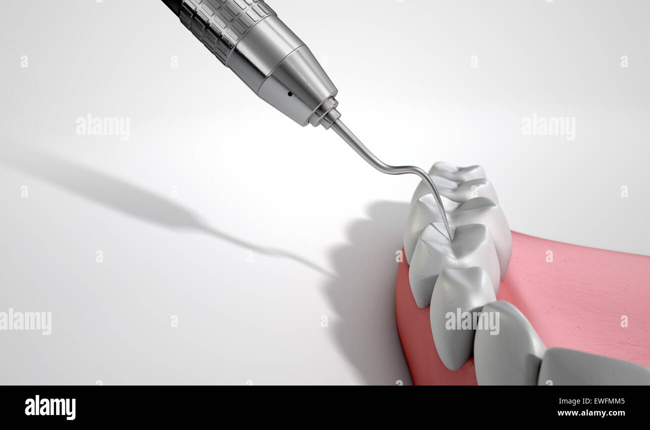 A closeup of a steel dentists hook probe performing an examination on a ...