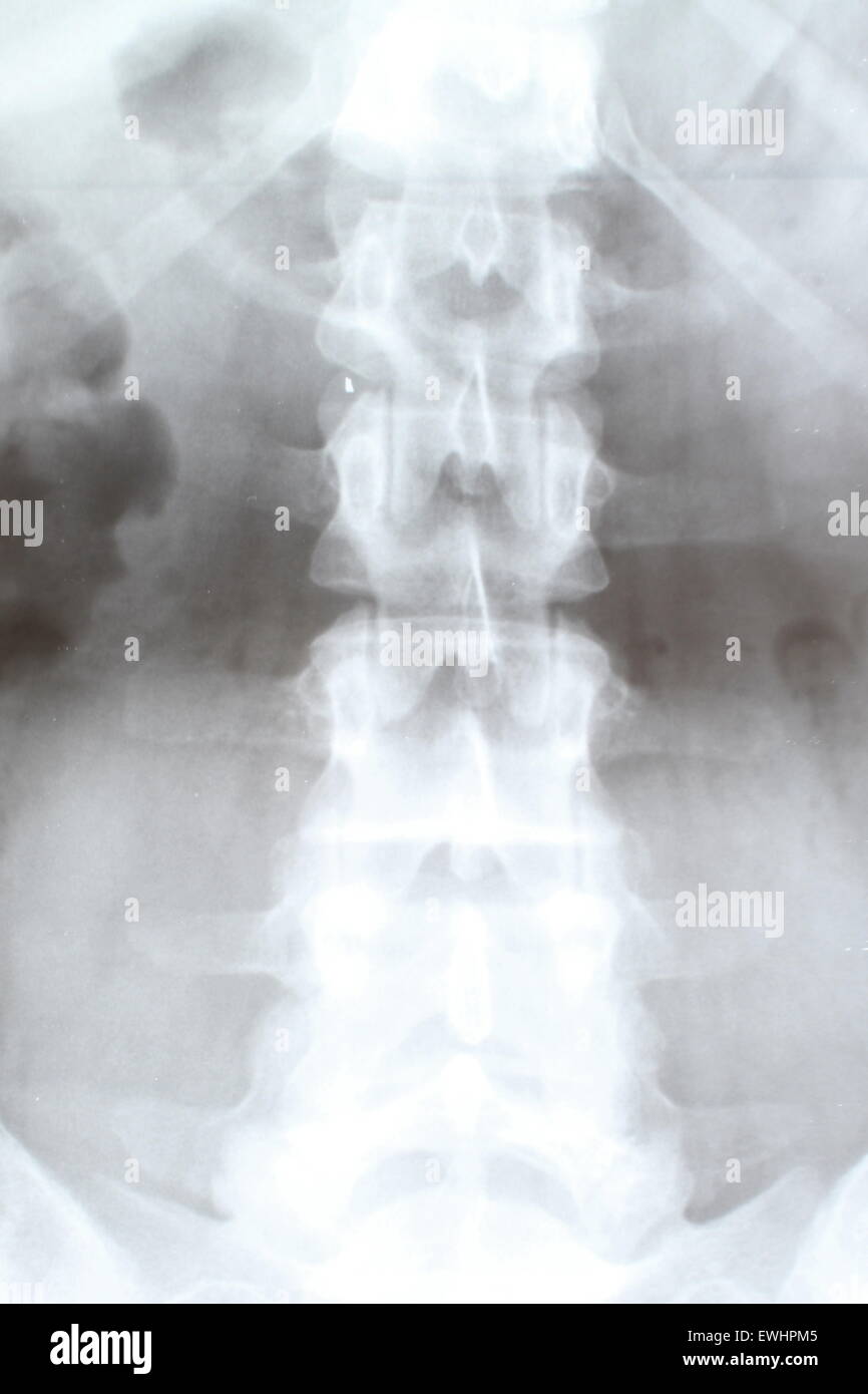 Spinal column hi-res stock photography and images - Alamy
