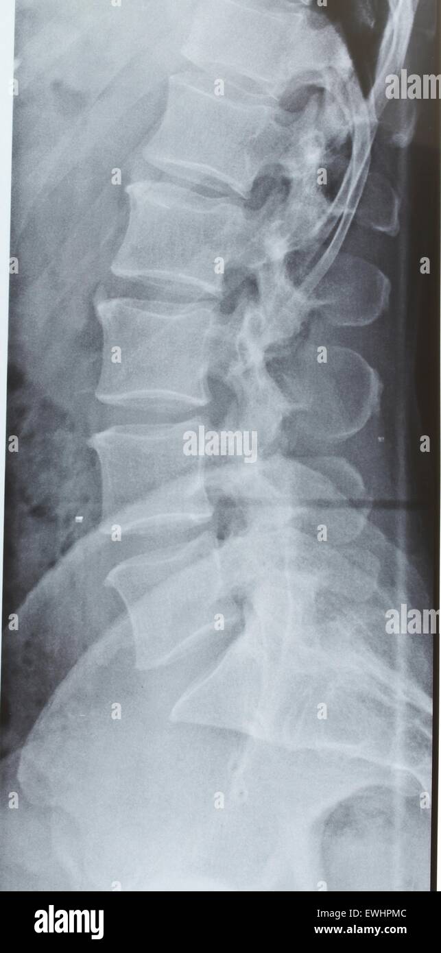 Slab of a spinal column of a man Stock Photo - Alamy