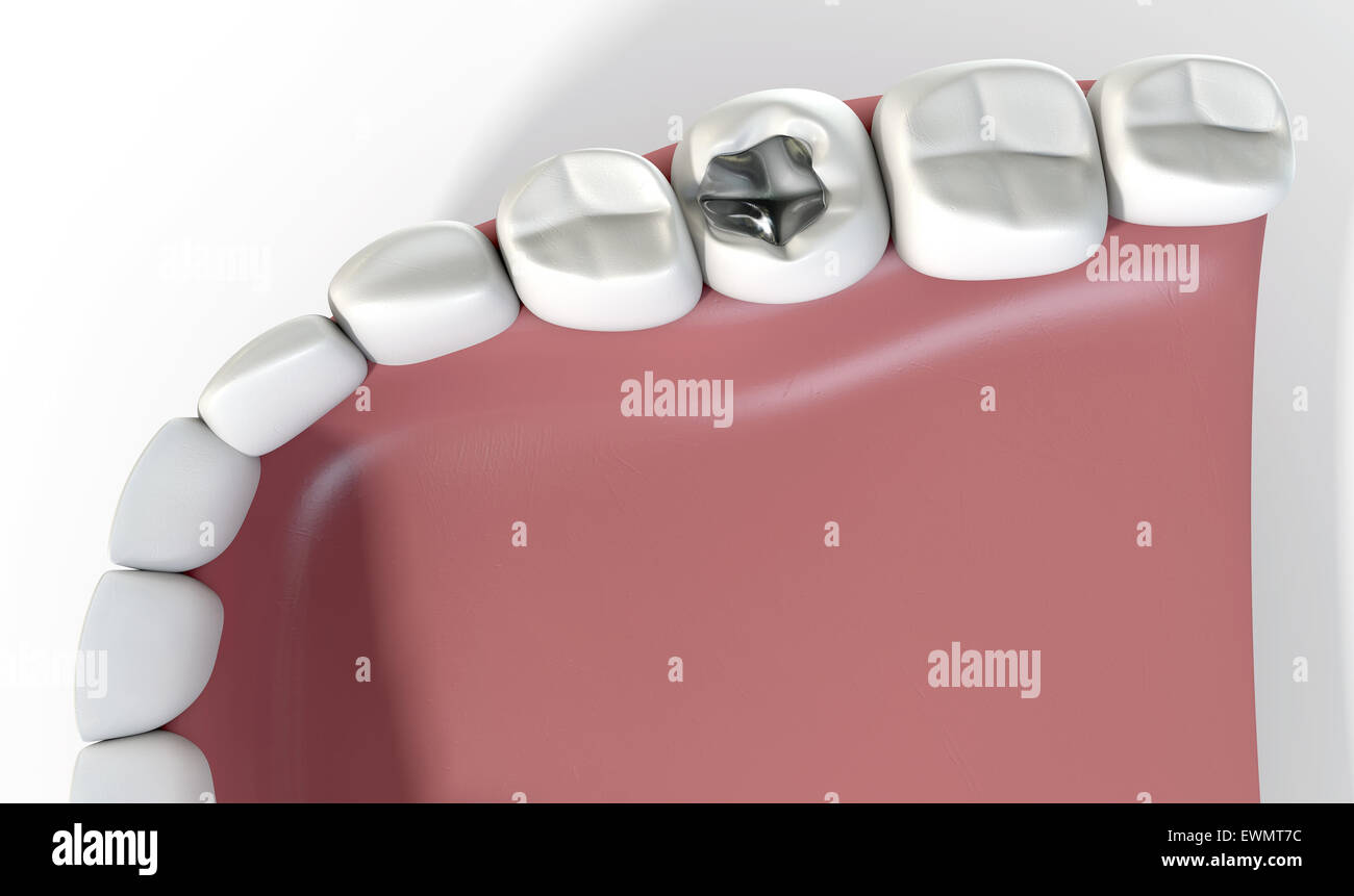 A lead cavity filling on one molar in a set of false human teeth set in ...