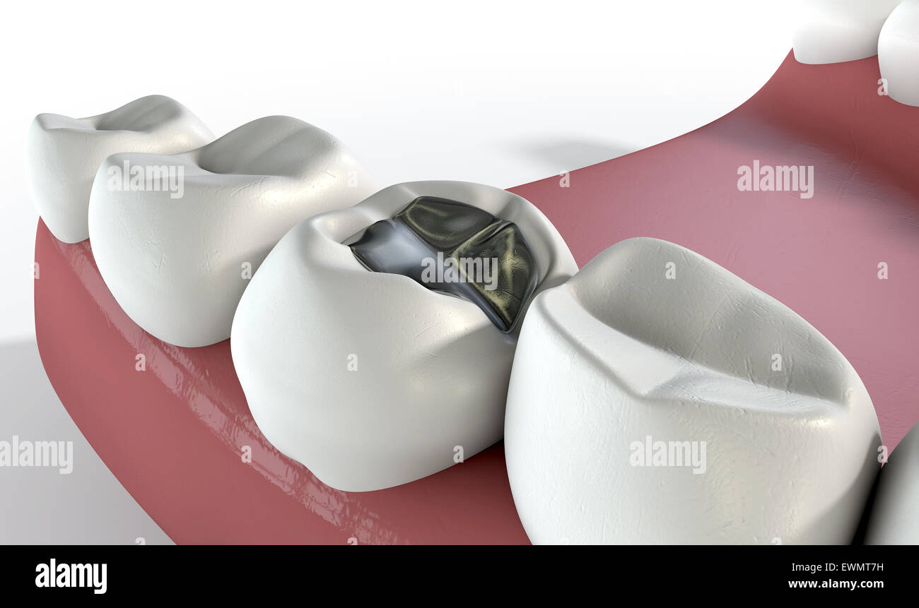 A lead cavity filling on one molar in a set of false human teeth set in ...