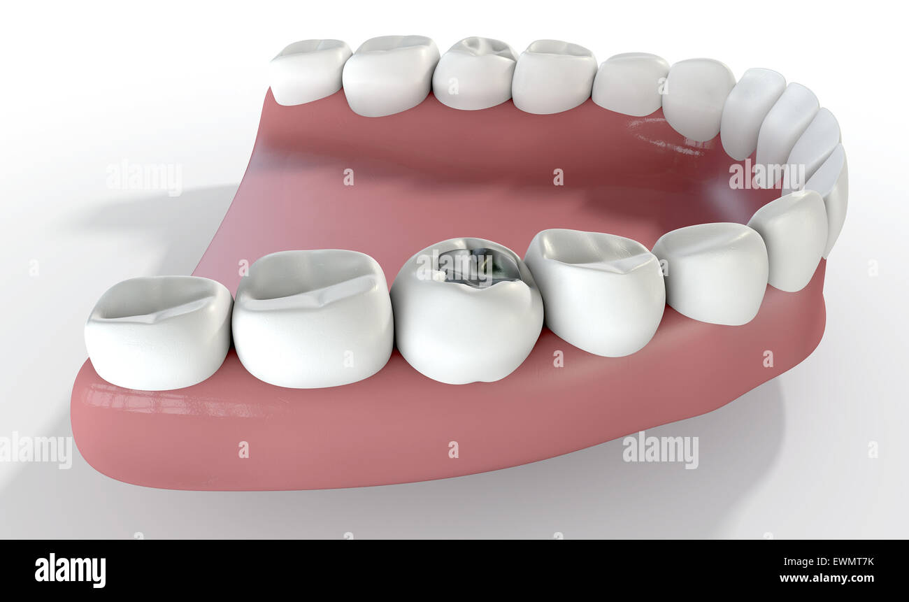 A lead cavity filling on one molar in a set of false human teeth set in ...