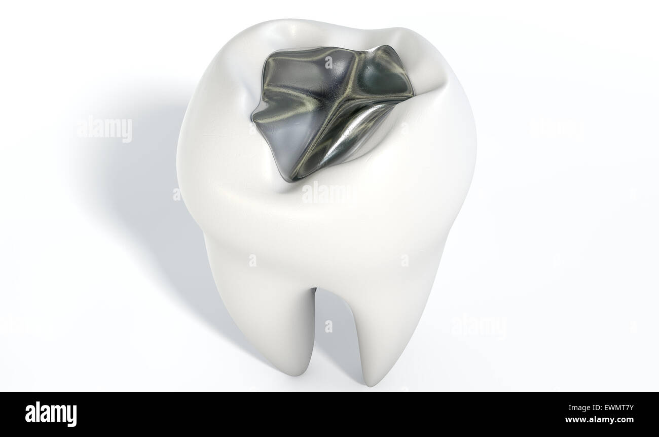 A lead cavity filling on a single molar on an isolated background Stock ...