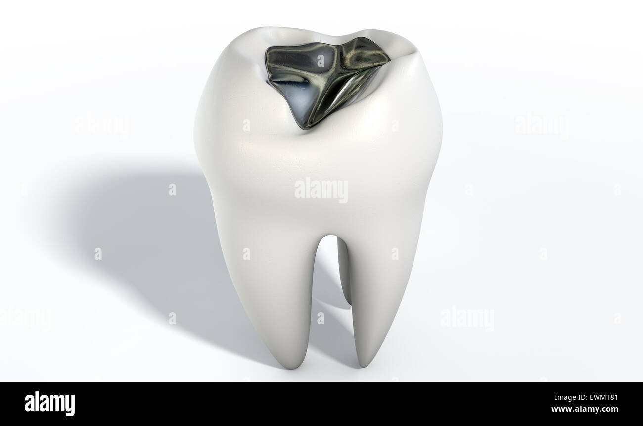 A lead cavity filling on a single molar on an isolated background Stock ...