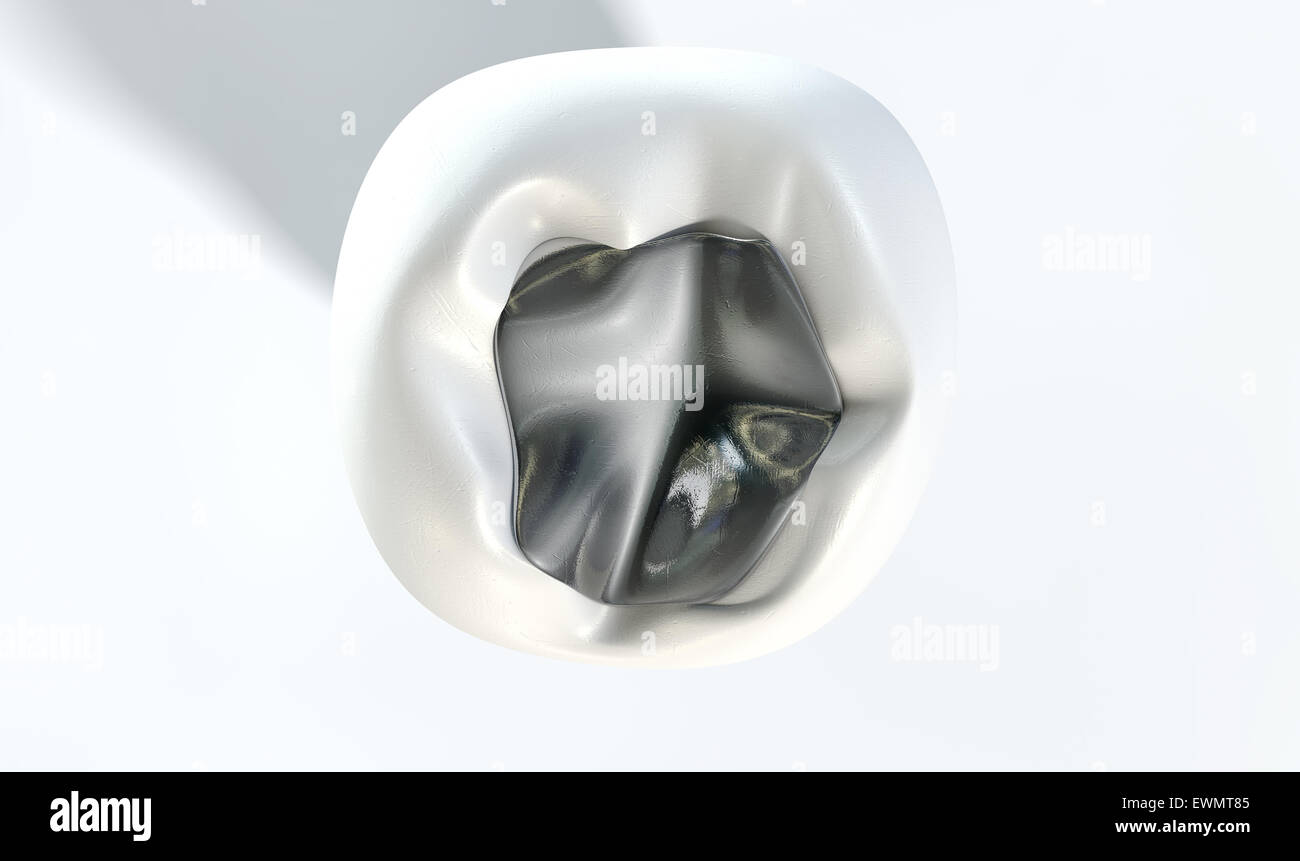 A lead cavity filling on a single molar on an isolated background Stock ...
