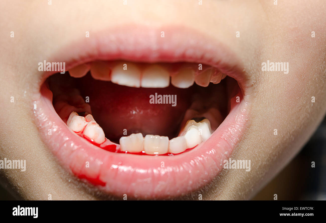 little girl and broken teeth Stock Photo - Alamy