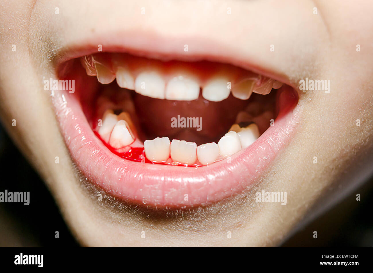 Kids teeth hi-res stock photography and images - Alamy