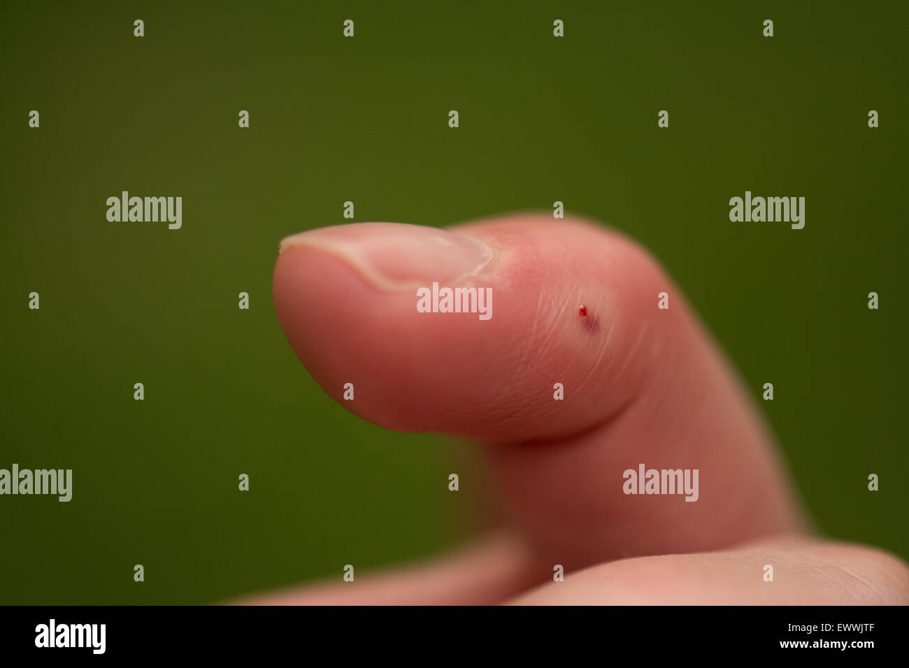 Bee sting hand hi-res stock photography and images - Alamy