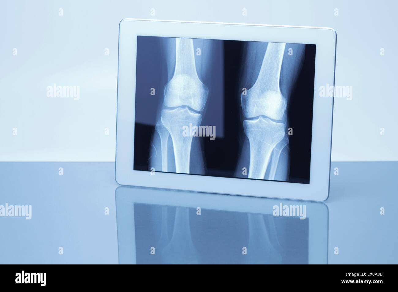 Digital tablet displaying X-ray image of knees Stock Photo - Alamy