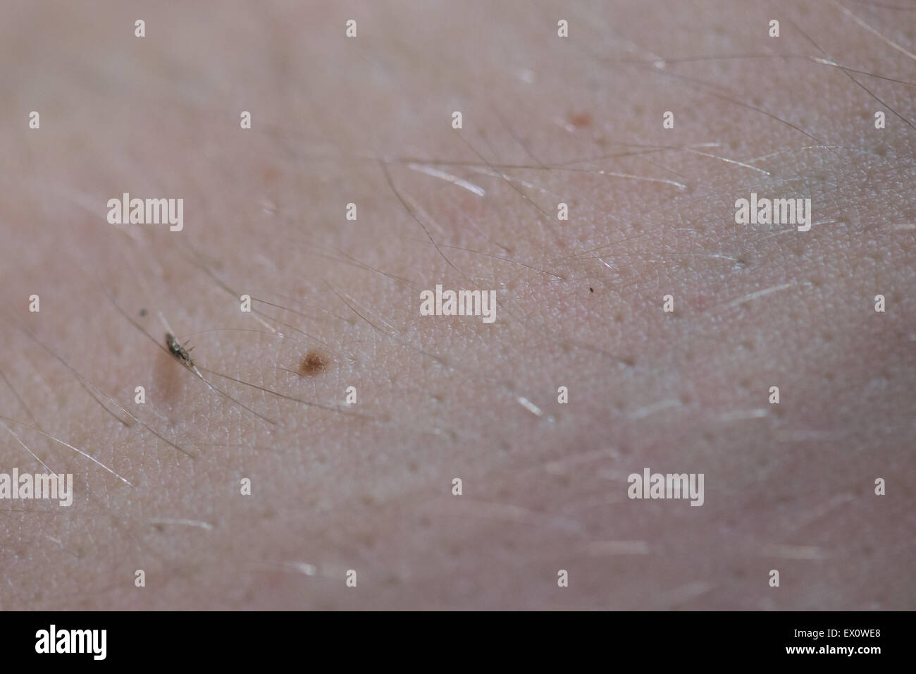 Head lice hair hi-res stock photography and images - Alamy