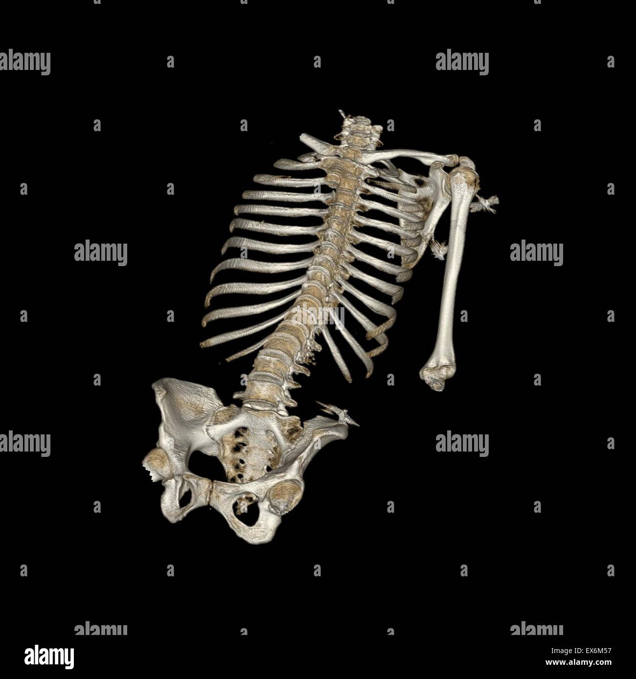 Skeletal reconstruction, 2003, Institute of Forensic Medicine ...