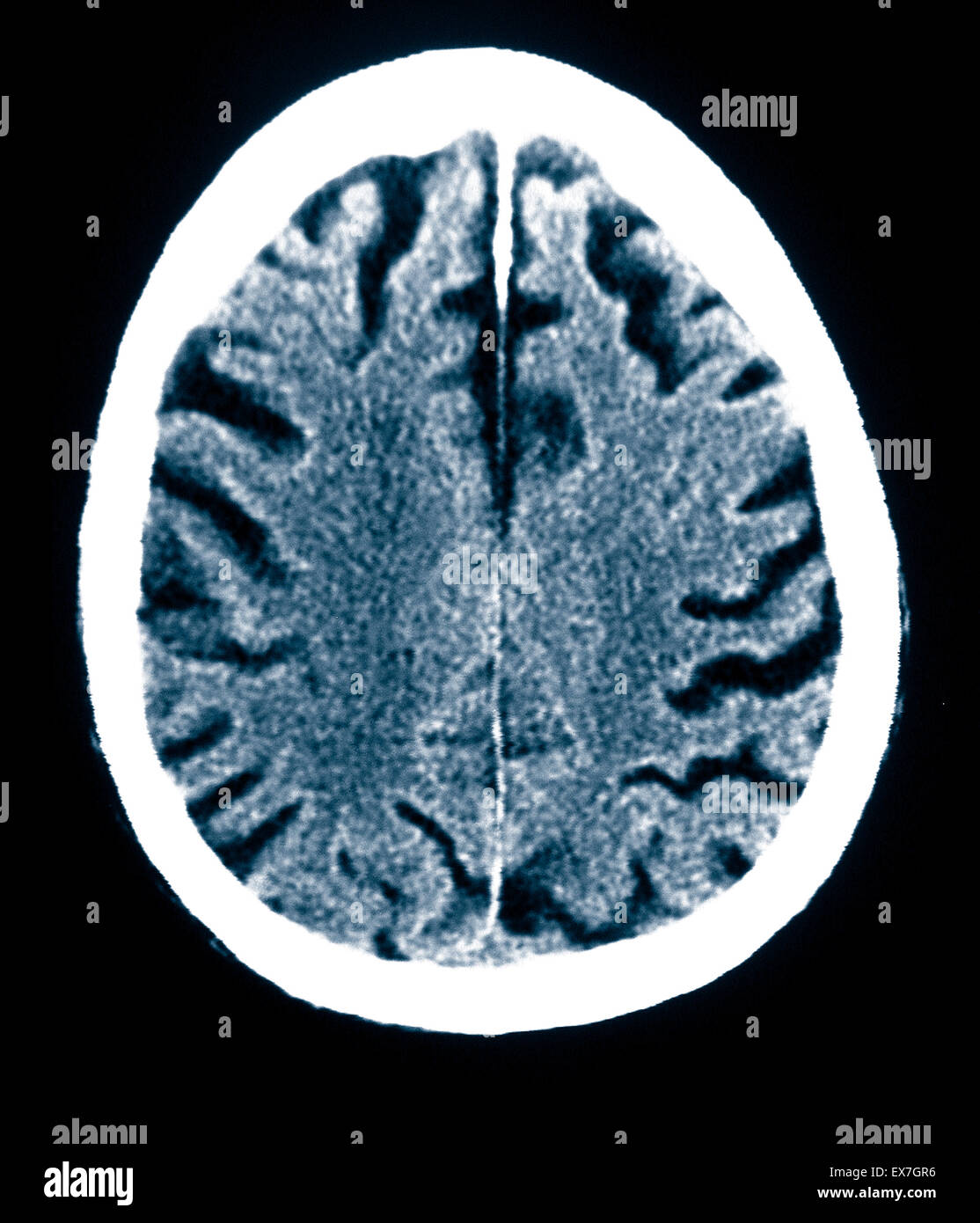 CT scan of an 84 year old man with Alzheimer's disease. CT shows brain ...