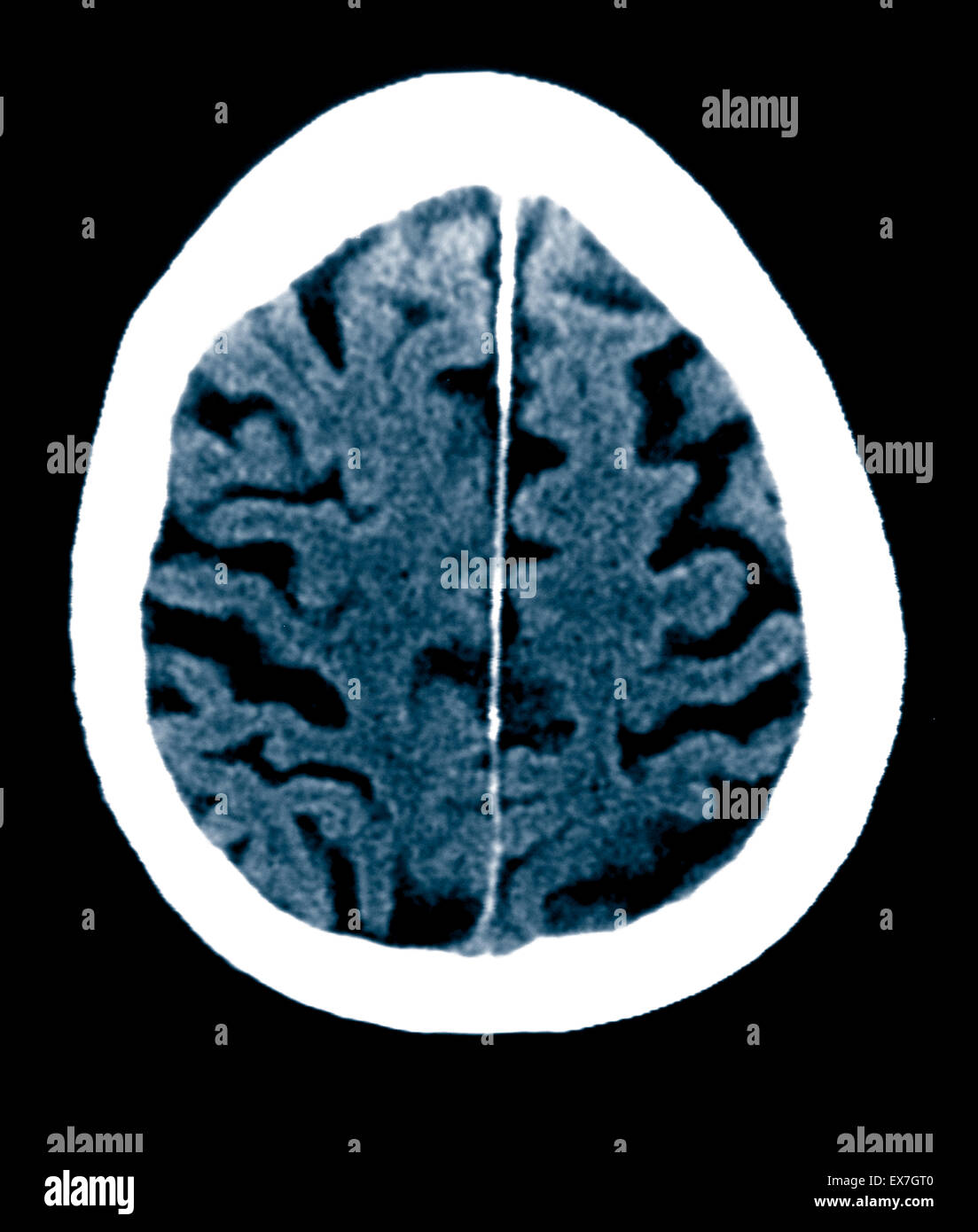 CT scan of an 84 year old man with Alzheimer's disease. CT shows brain ...