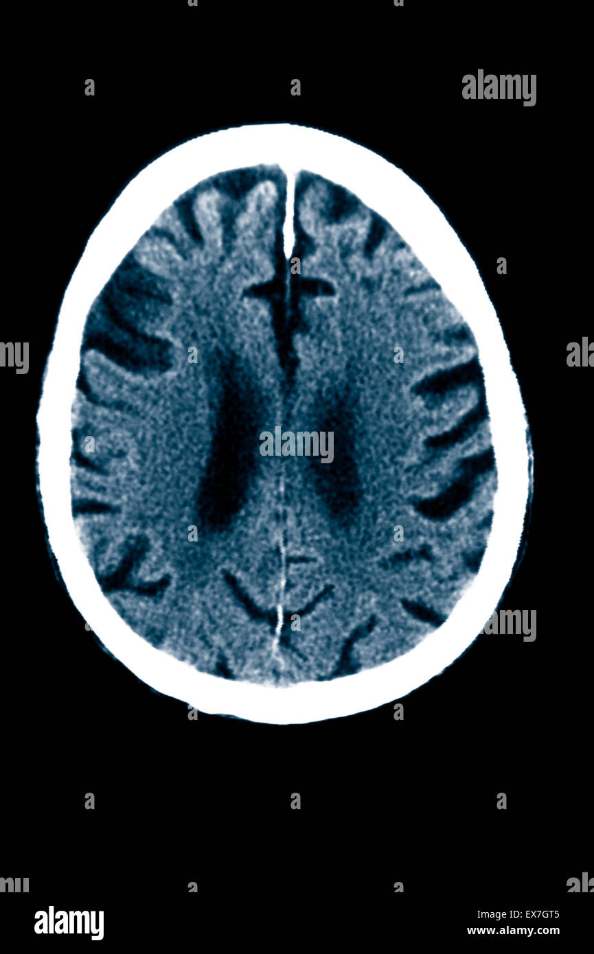 CT scan of an 84 year old man with Alzheimer's disease. CT shows brain ...