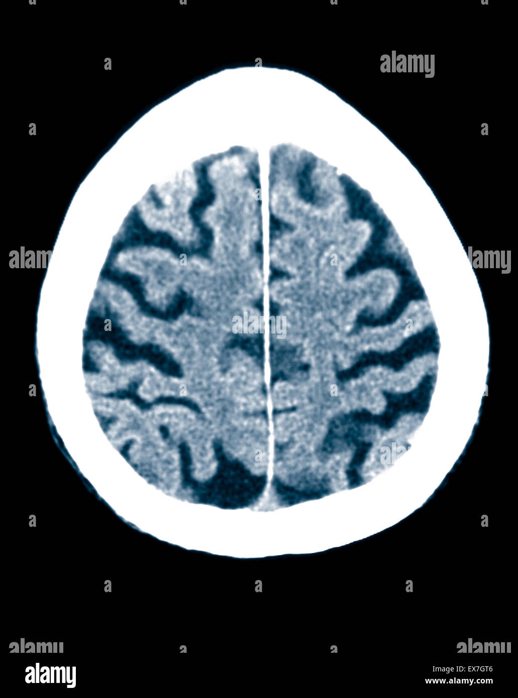 CT scan of an 84 year old man with Alzheimer's disease. CT shows brain ...