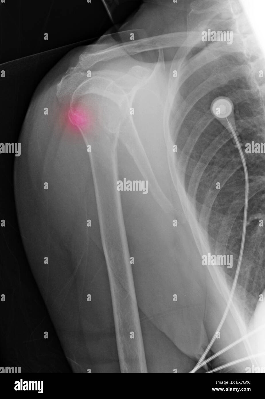 88 year old female with upper humerus fracture, and history of ...
