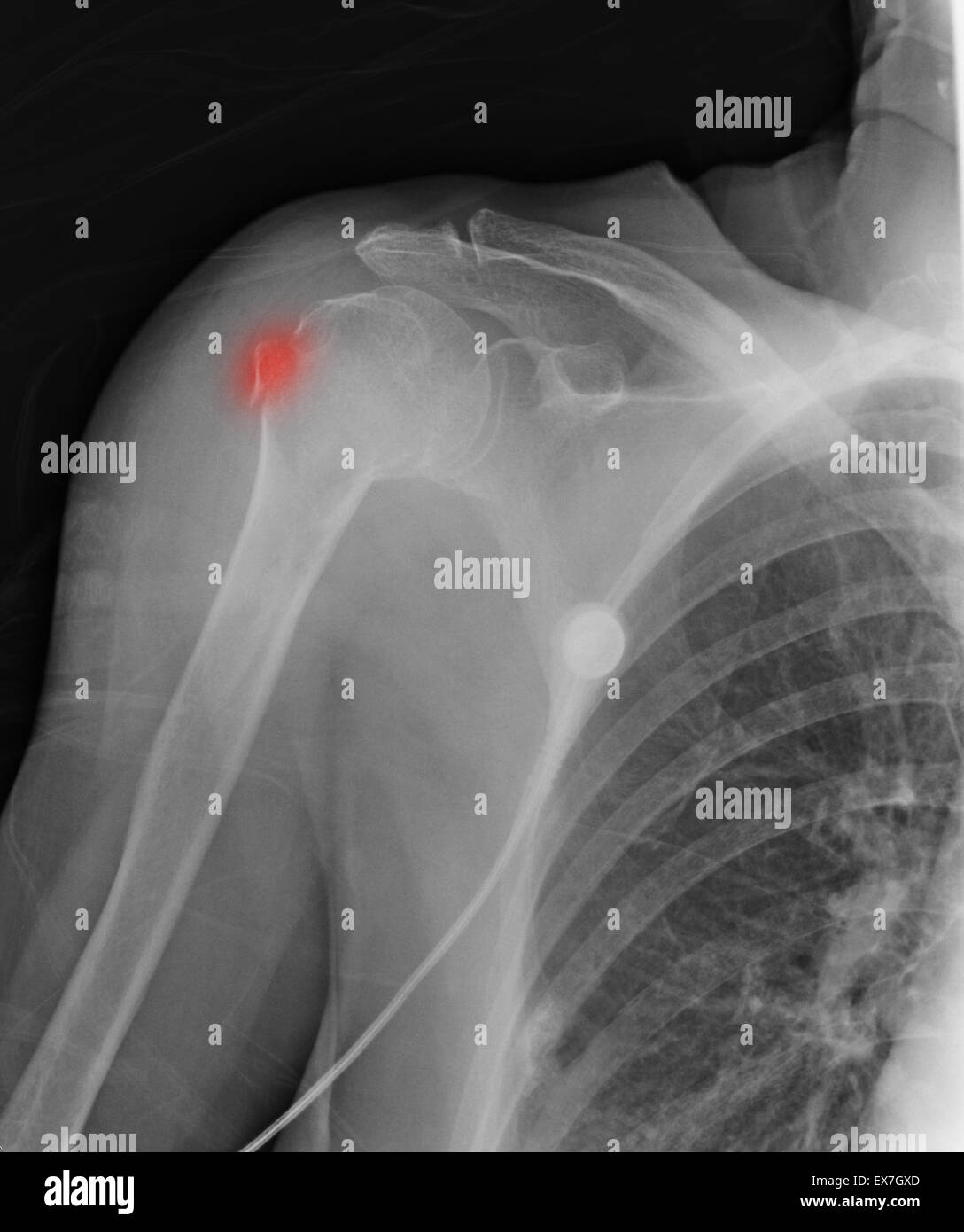 Comminuted Fracture Humeral Neck