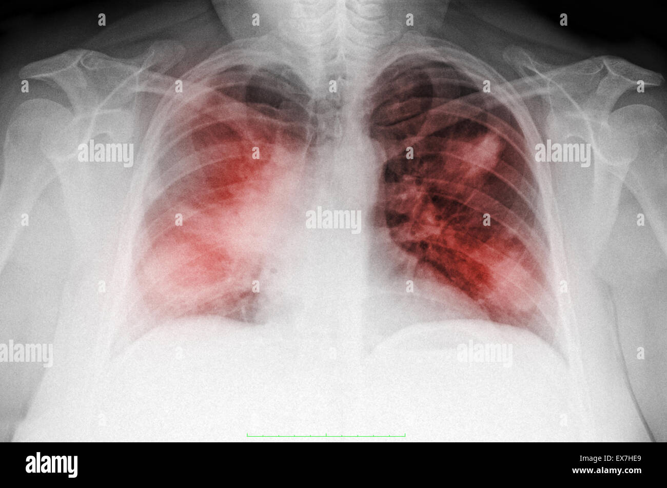 Chest x-ray of a 44 year old woman smoker showing diffuse interstitial ...