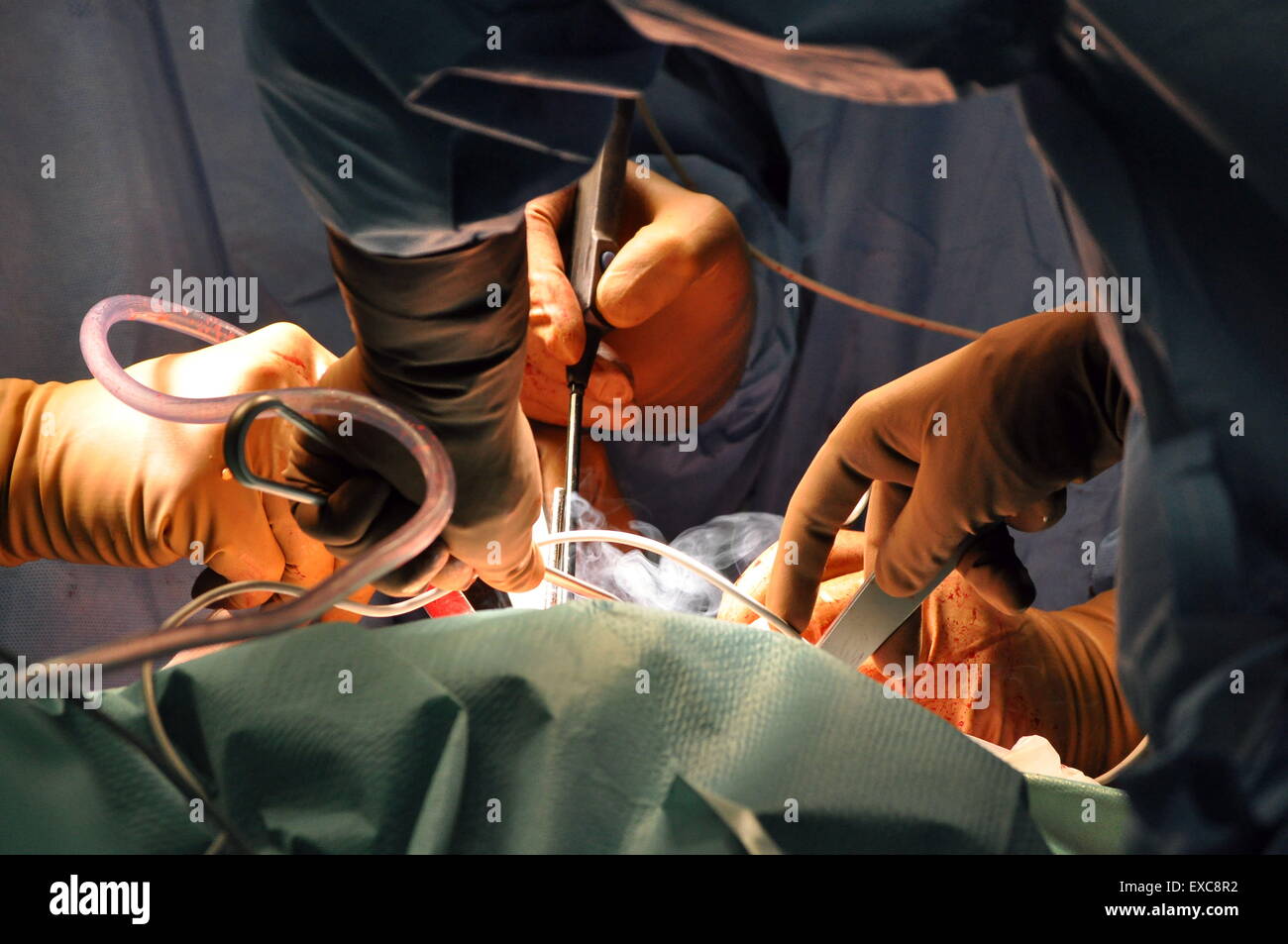 Human hip operation hi-res stock photography and images - Alamy
