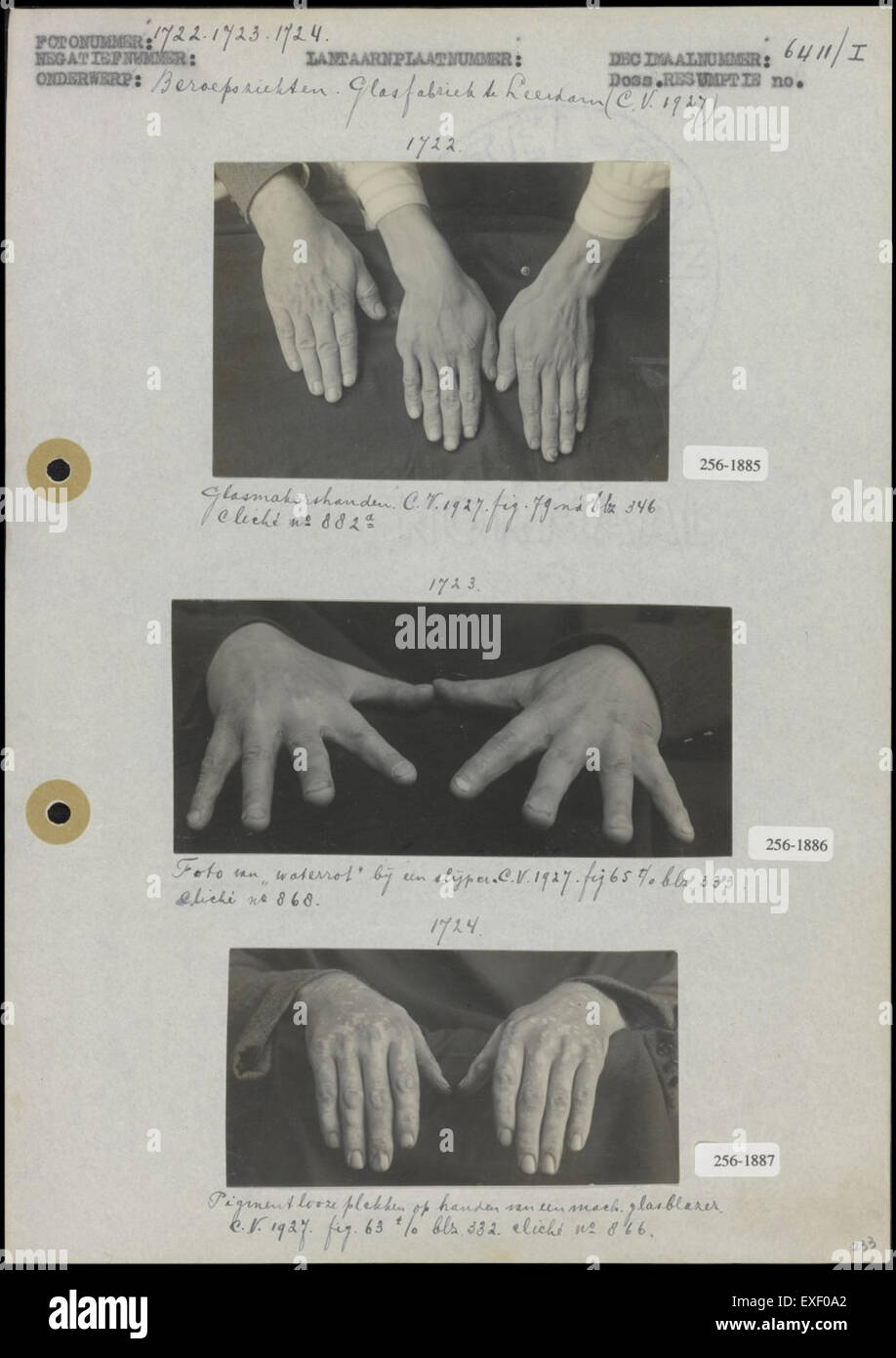 The image highlights occupational diseases at the Glass Factory in ...