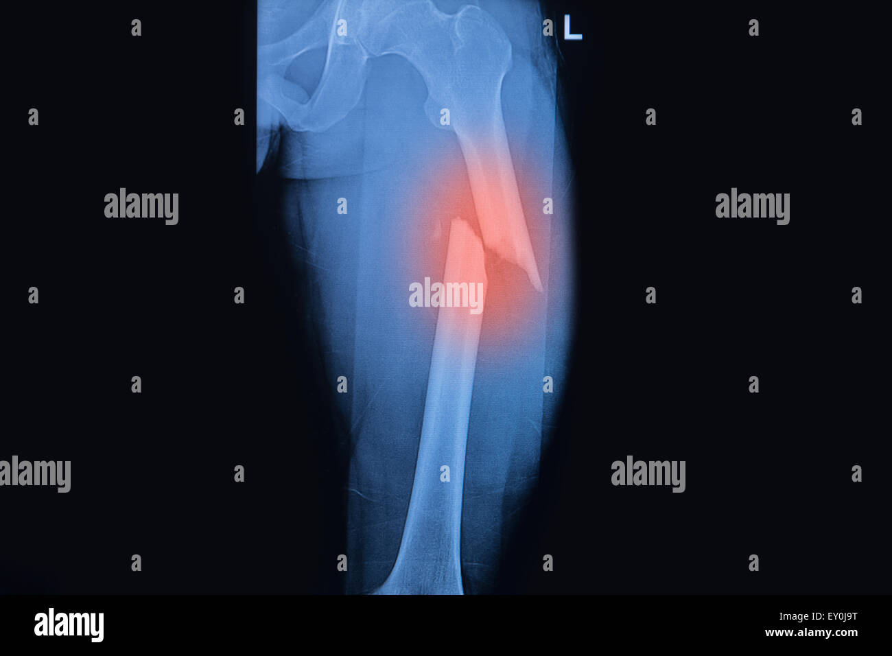 Fractured Femur, Broken thigh x-rays image Stock Photo - Alamy