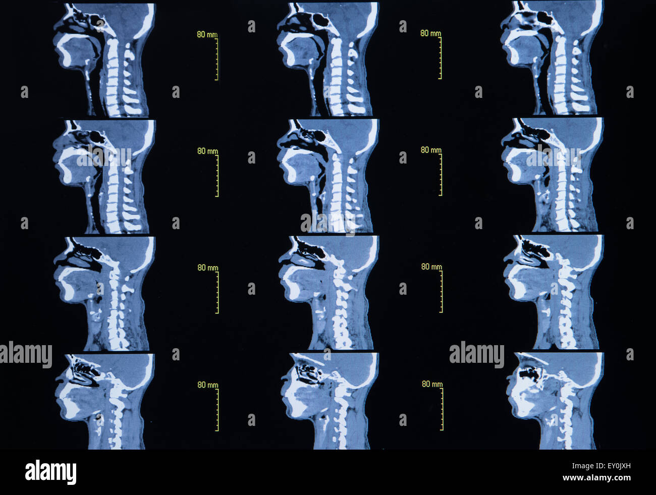 Series of images from a computerized tomography of neck (cervical bone ...