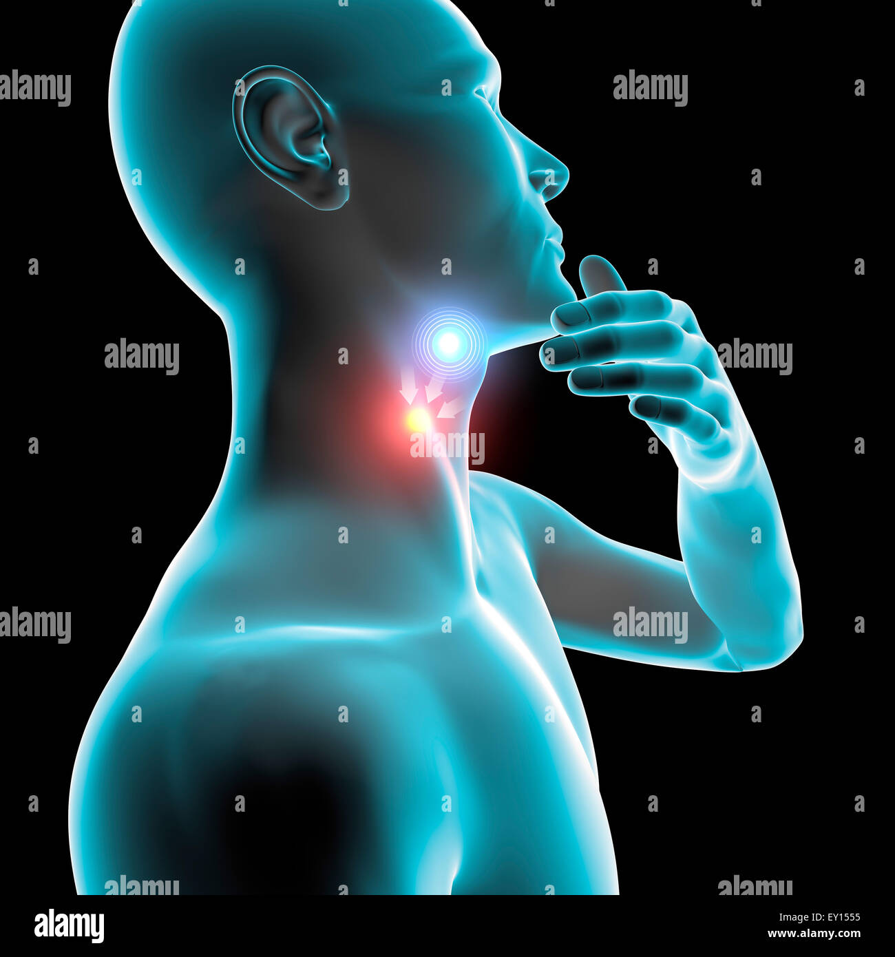 Sore throat that spreads around the neck Stock Photo - Alamy