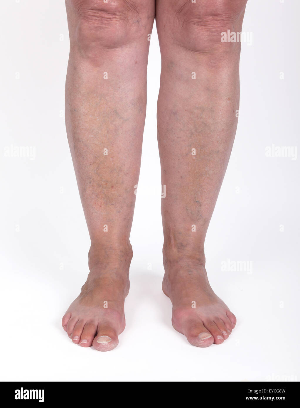 Varicose veins operation hi-res stock photography and images - Alamy