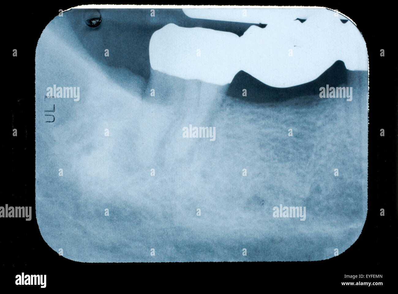 A periacical x-ray shows an abcess on a lower right number 31 tooth ...