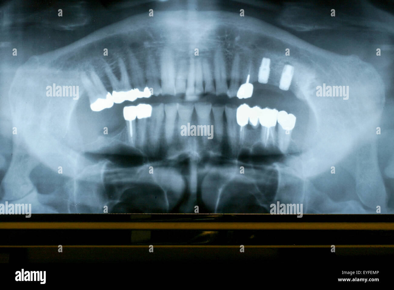 The Panorex X-ray is a single picture of all teeth and surrounding ...