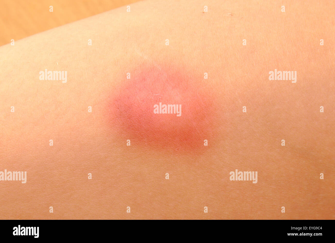 Bruise woman hi-res stock photography and images - Alamy